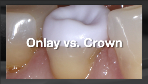 Cerec onlay - falasafro