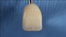 CEREC Implant ScanPost/ScanBody Digital Impression | CADStar