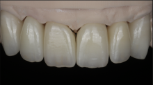CEREC Implant ScanPost/ScanBody Digital Impression | CADStar